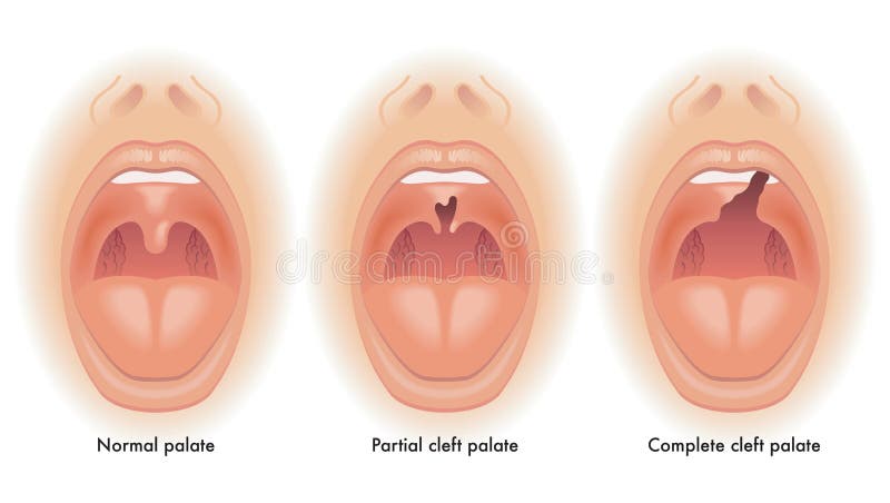 Cleft Palate Stock Illustrations – 64 Cleft Palate Stock Illustrations, Vectors & Clipart ...