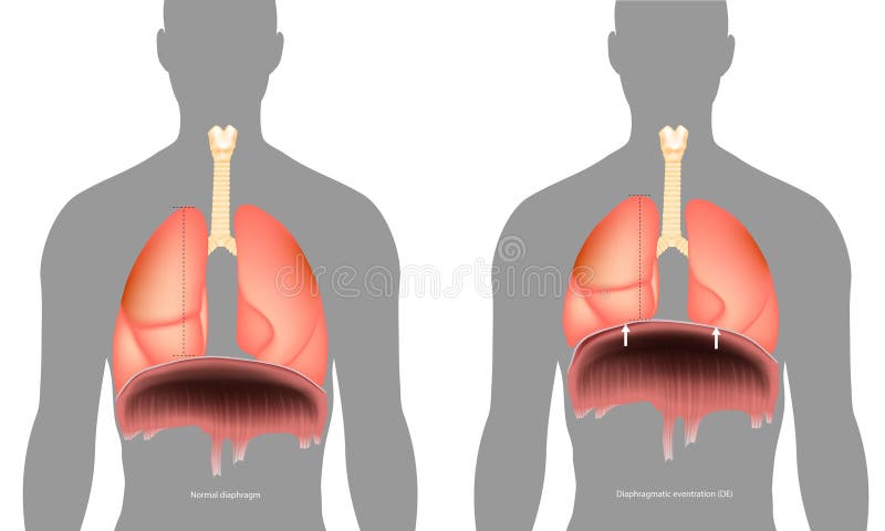 Normal Diaphragm or Diaphragmatic Eventration. Abnormal Elevation of a ...