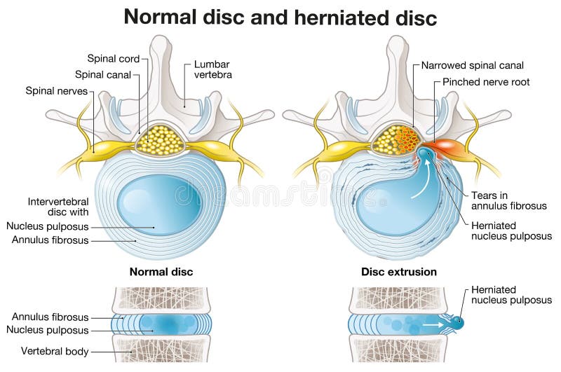 Normal Disc and Herniated Disc, Slipped Disc, Labelde Illustration ...