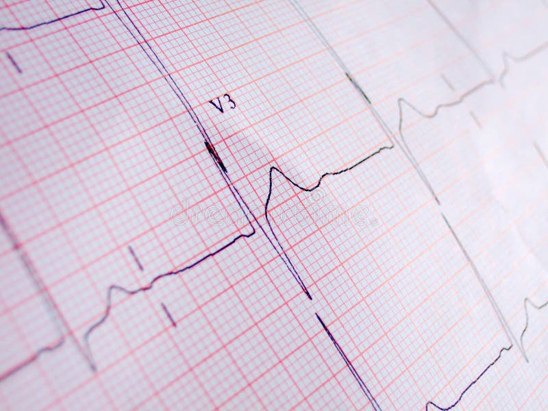 Normal ECG stock photo. Image of healthcare, screen, cardiologist - 1842238