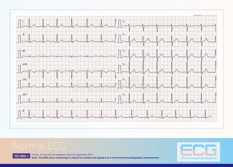 Normal Right Ventricular Area Stock Photos - Free & Royalty-Free Stock ...