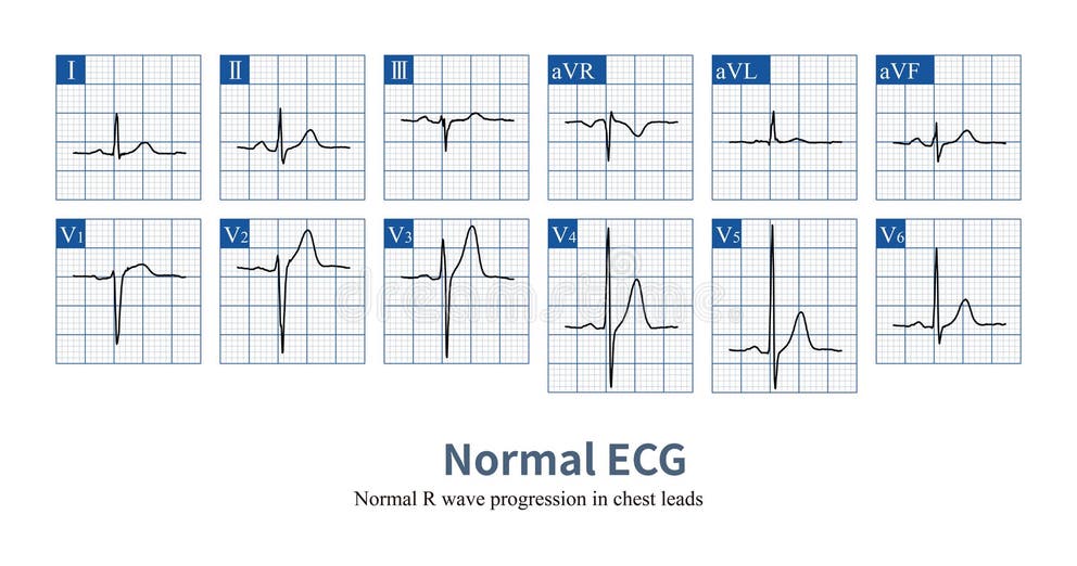 Normal ECG stock illustration. Illustration of repolarization - 348425630