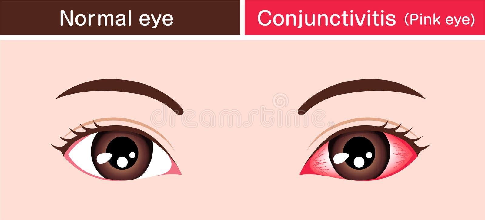 Conjunctivitis or Pink Eye Symptoms with Medical Examples Outline ...