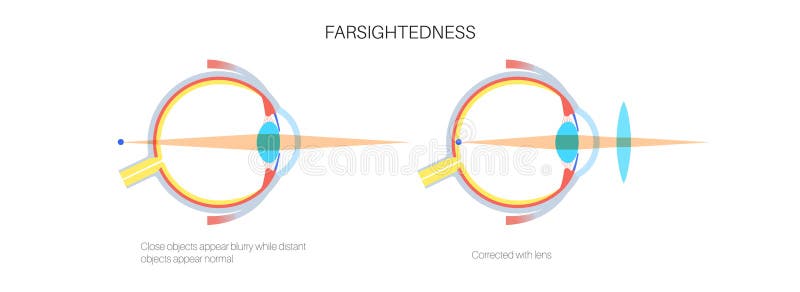 Normal Eye and Farsightedness Stock Vector - Illustration of sclera ...
