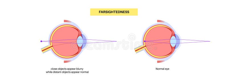 Normal Eye and Farsightedness Stock Vector - Illustration of surface ...