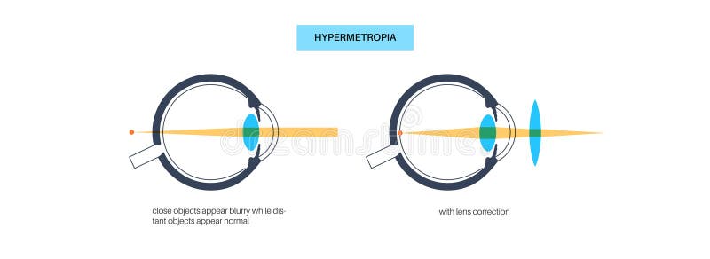 Normal Eye and Farsightedness Stock Vector - Illustration of retina ...