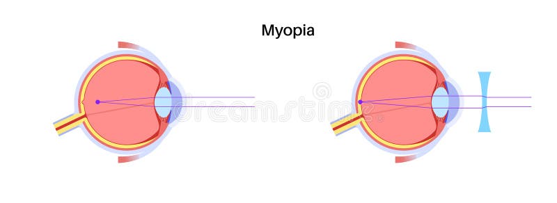 Normal Eye and Nearsightedness Stock Vector - Illustration of human ...