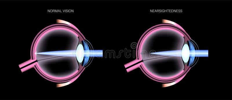 Normal Eye and Nearsightedness Stock Vector - Illustration of pupil ...