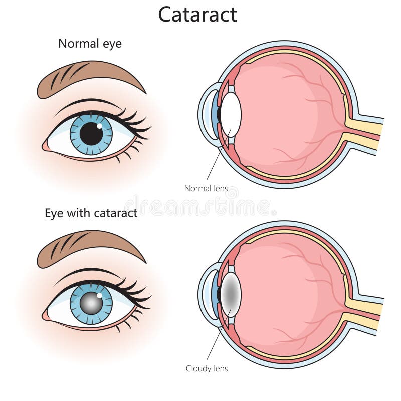 Cataract Structure Diagram Medical Science Stock Illustration ...