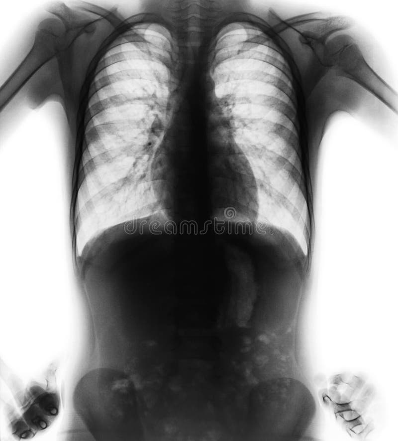 Normal Film Chest X-ray Akimbo Position Front View Stock Image - Image ...