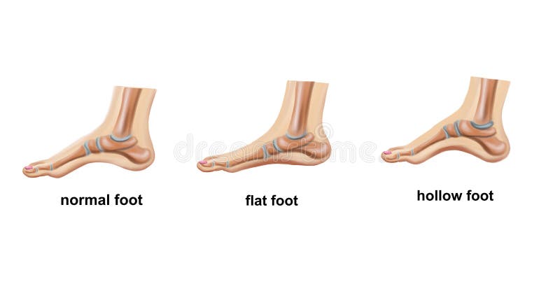 Normal Foot, Flat Foot and Hollow Foot Stock Illustration ...