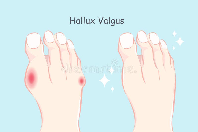 Normal Foot and a Foot with a Fat Pad Atrophy / Callus Stock Vector ...