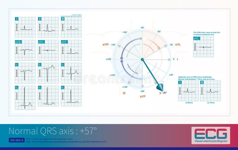 Normal frontal QRS axis stock illustration. Illustration of lead ...