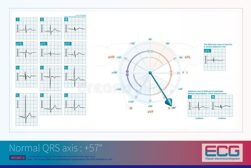Normal frontal QRS axis stock photo. Image of deviation - 360152974