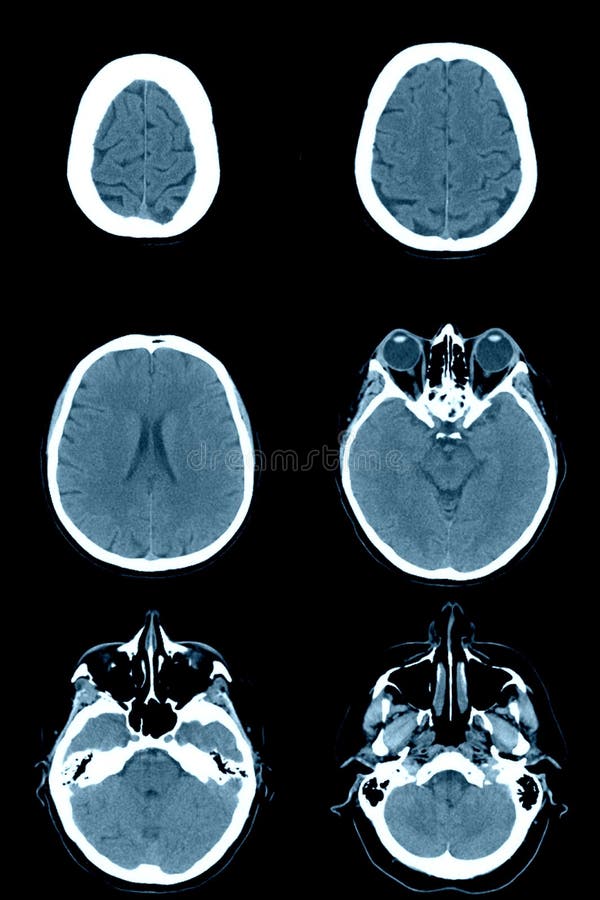 Normal head on CT scans stock photo. Image of human, matter - 55979524