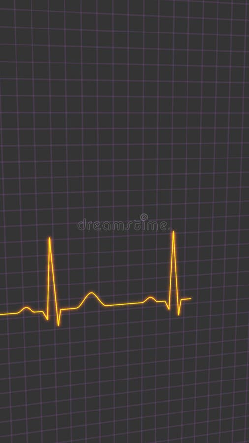 Normal Heart Rhythm ECG Electrocardiogram of a Healthy Person, Heart ...
