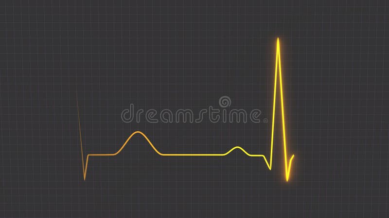 Normal Heart Rhythm ECG Electrocardiogram of a Healthy Person, Heart ...