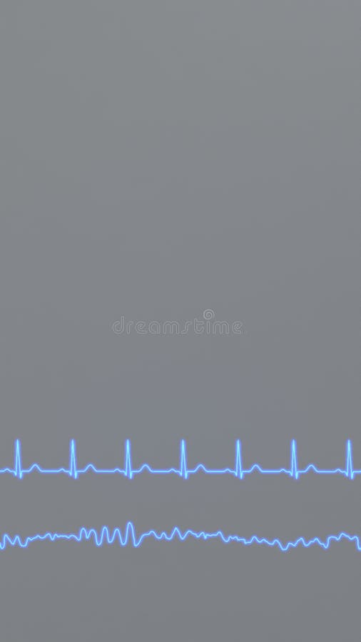 Normal Heart Rhythm ECG and Ventricular Fibrillation Stock Image ...