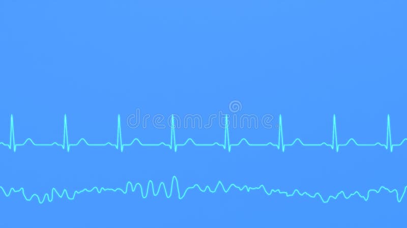 Normal Heart Rhythm ECG and Ventricular Fibrillation Stock Illustration ...
