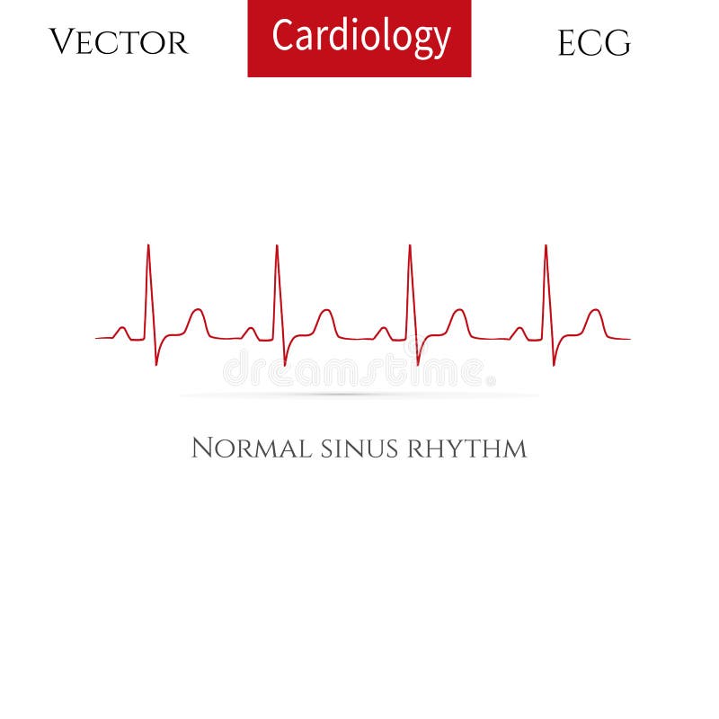Heart Normal Sinus Rhythm On Electrocardiogram Stock Vector ... Heart Normal Sinus Rhythm On Electrocardiogram Stock Vector ...