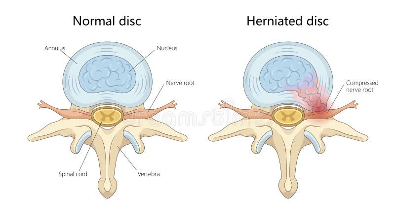 Normal and Herniated Spinal Discs Diagram Medical Stock Vector ...