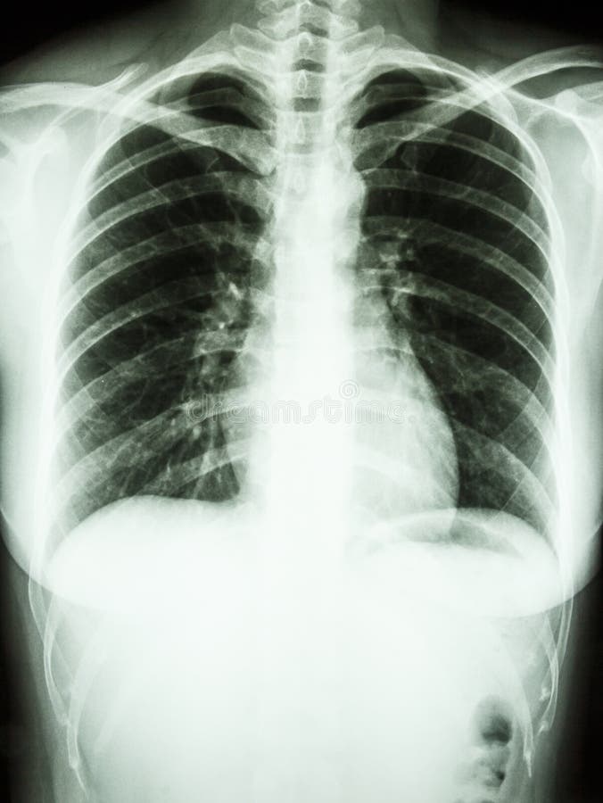 Normal Chest X-ray of Old Patient . You Can Seen Calcification at Rib ...
