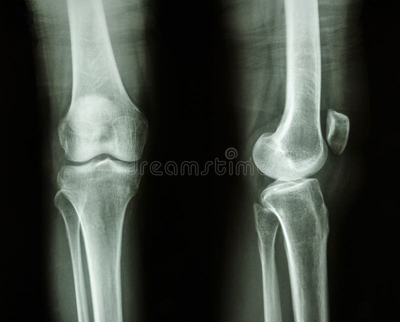 Normal Knee xray stock photo. Image of radiology, hospital - 14088732