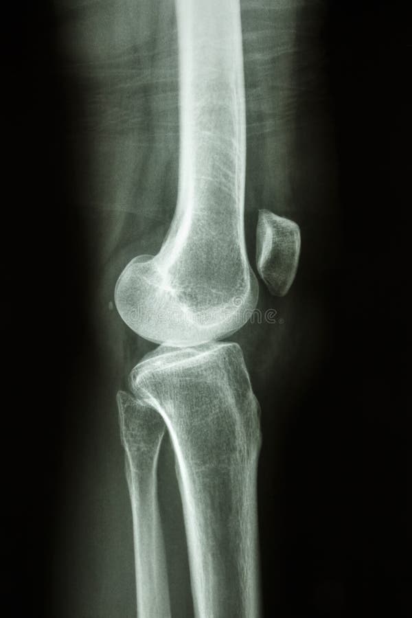 Normal Knee and Osteoarthritis Knee Stock Photo - Image of inflammation ...