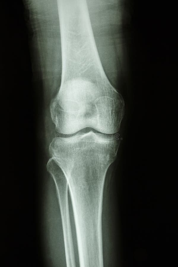 Normal Knee Joint