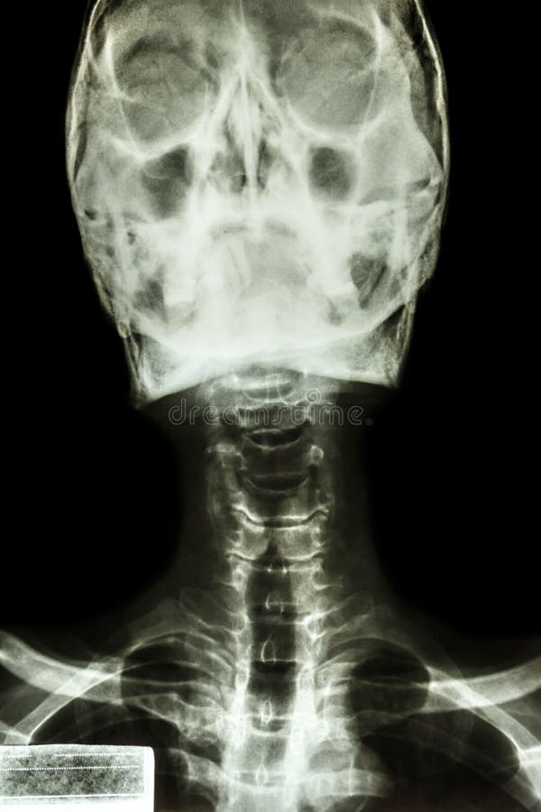 Normal Human S Skull and Cervical Spine Stock Image - Image of black ...