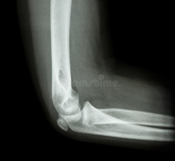 Normal humans elbow stock photo. Image of body, forearm - 38376136