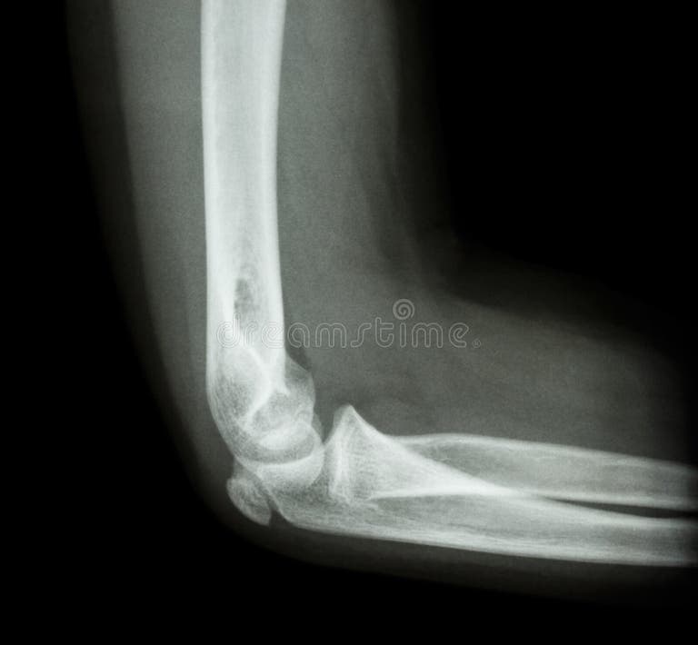 Normal humans elbow stock photo. Image of body, forearm - 38376136