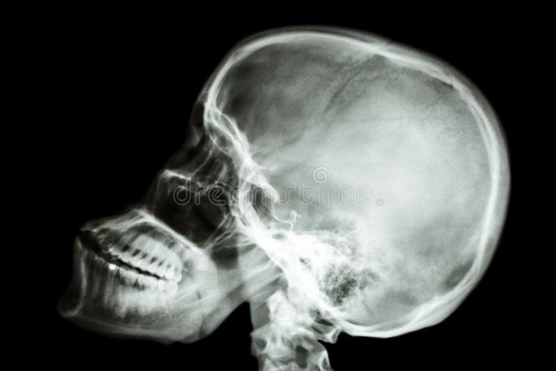Normal Humans Skull and Cervical Spine Stock Photo - Image of head ...