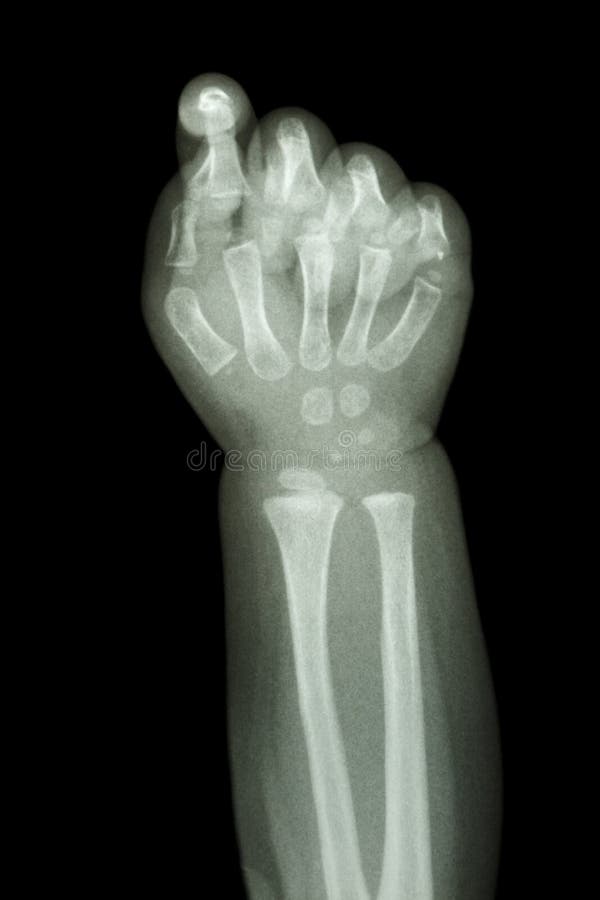 Normal infant s hand bone stock photo. Image of medicine - 37896474