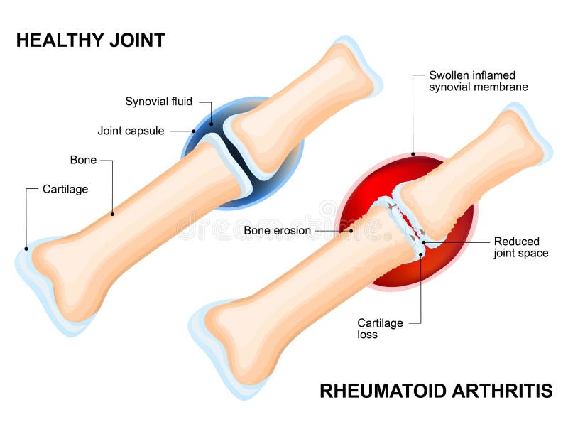 Normal Joint and Rheumatoid Arthritis Stock Vector - Illustration of ...
