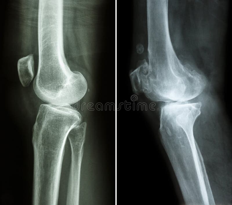 Normal Knee Left Image and Osteoarthritis Knee Right Image Lateral View ...