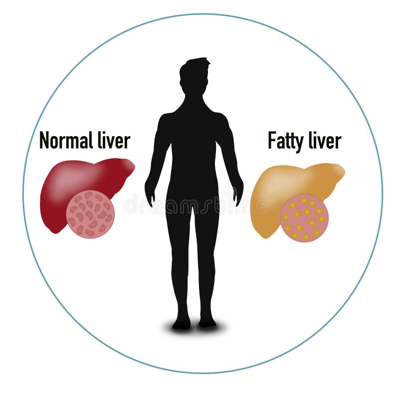 Normal Liver and Fatty Liver, Educational Sheet Stock Image - Image of ...