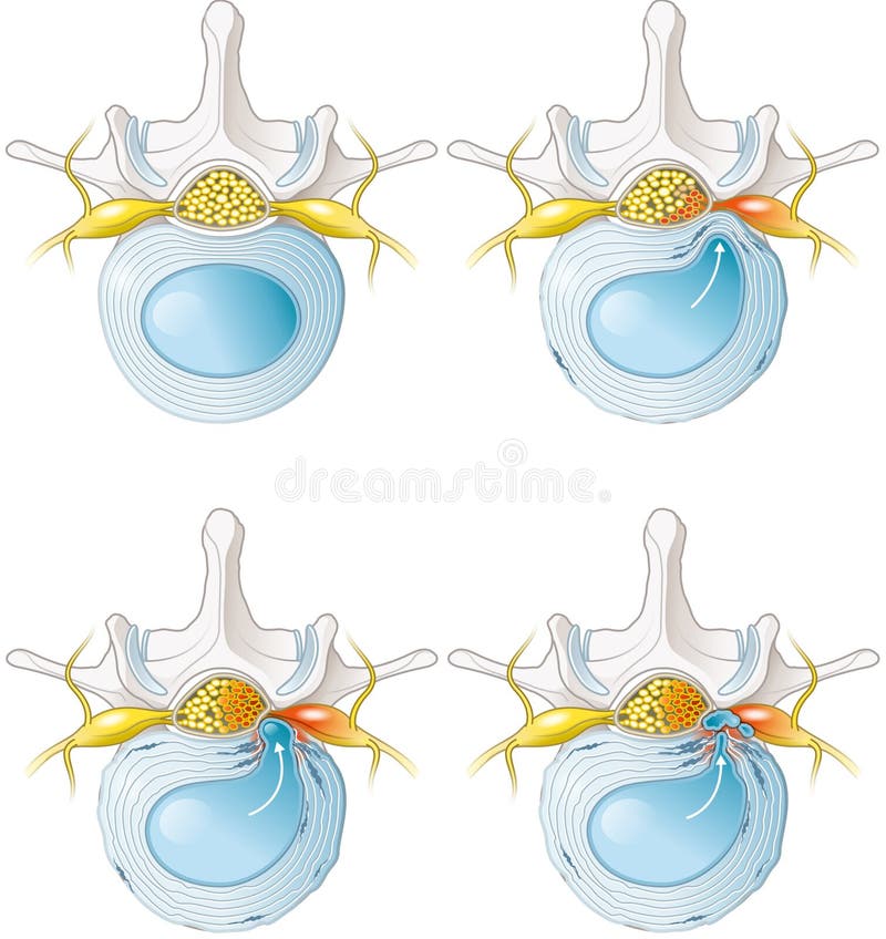 Normal Lumbar Disc. Disc Protrusion. Disc Extrusion. Disc Sequestion ...