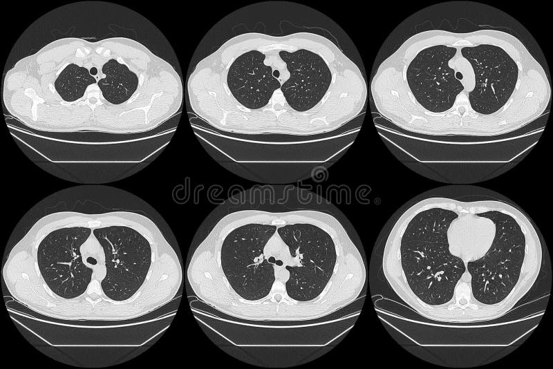 Normal Lungs on Computed Tomography Stock Photo - Image of breath ...