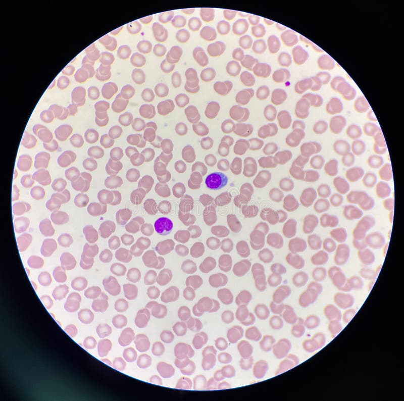 Normal Lyphocyte and Atypical Lymphocyte Stock Image - Image of life ...