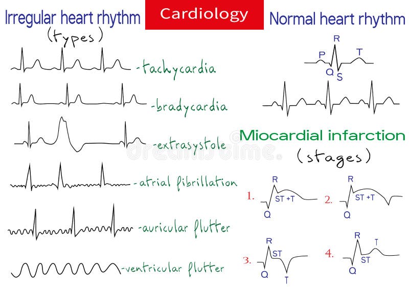 Normal and Pathological Ecg Collection. Stock Illustration ...