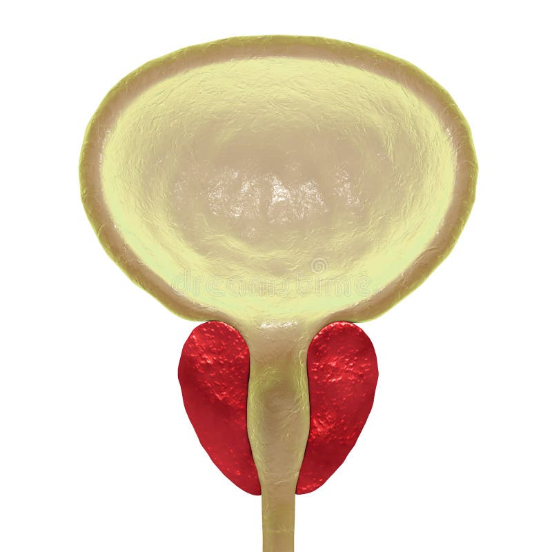 Normal Prostate and Benign Prostatic Hyperplasia Stock Vector ...