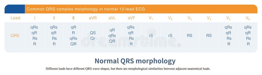 Normal QRS morphology stock illustration. Illustration of activity ...