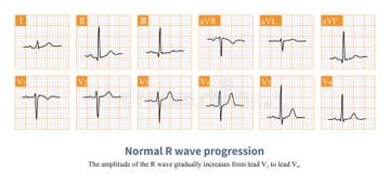 Normal R wave progression stock illustration. Illustration of heart ...