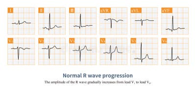 Normal R wave progression stock illustration. Illustration of heart ...