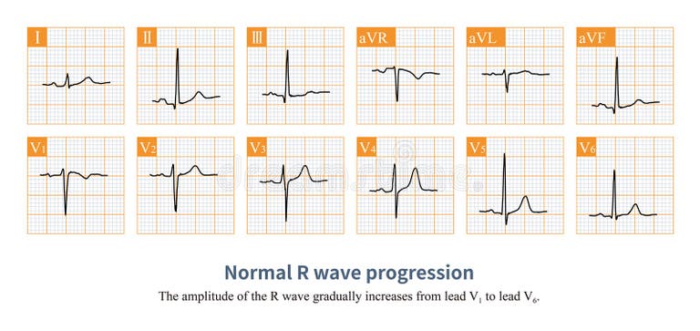 Normal R wave progression stock illustration. Illustration of heart ...