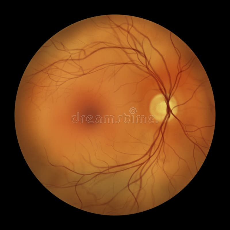 Normal Retina Stock Illustrations – 186 Normal Retina Stock ...