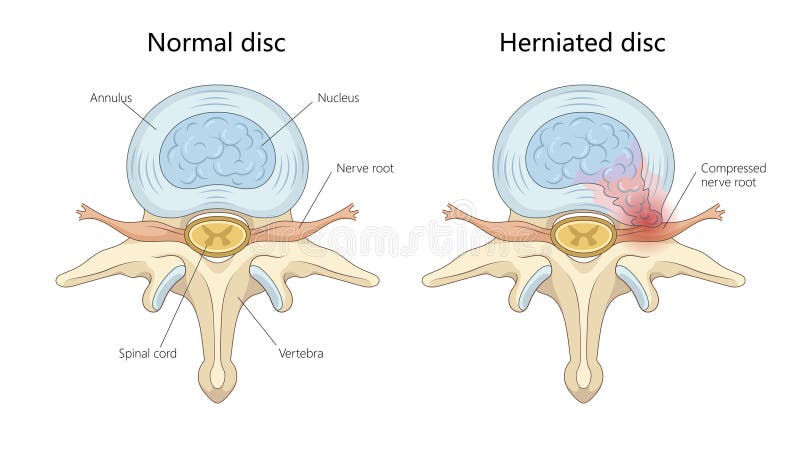 Normal and Herniated Spinal Discs Diagram Medical Stock Illustration ...