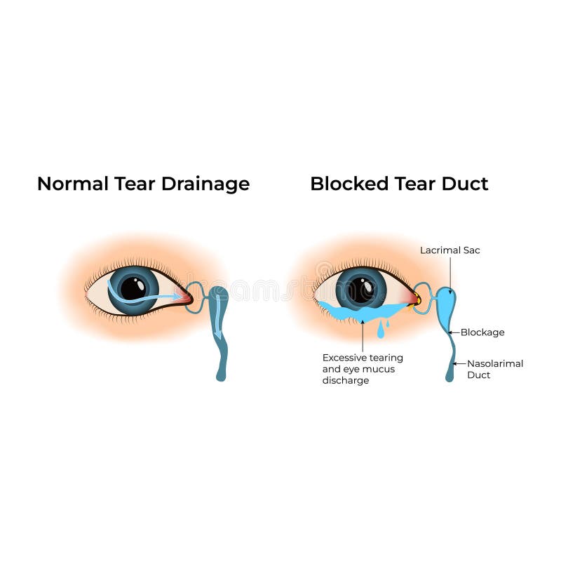 Blocked Tear Duct Diagram Medical Science Stock Illustration ...