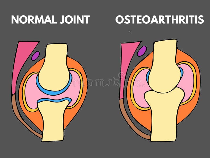 NORMAL VERSUS OSTEOARTHRITIS Joints Illustration Science Stock ...